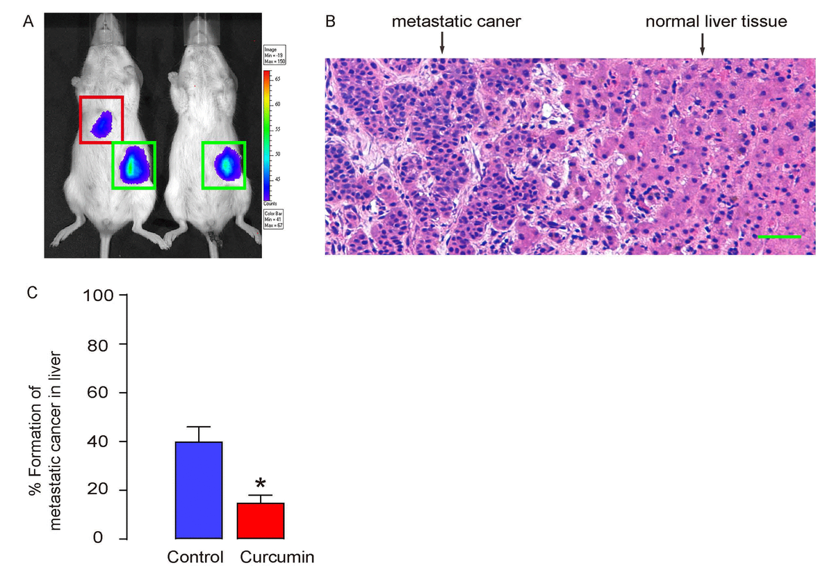 Curcumin inhibits liver metastasis of gastric cancer through reducing ...