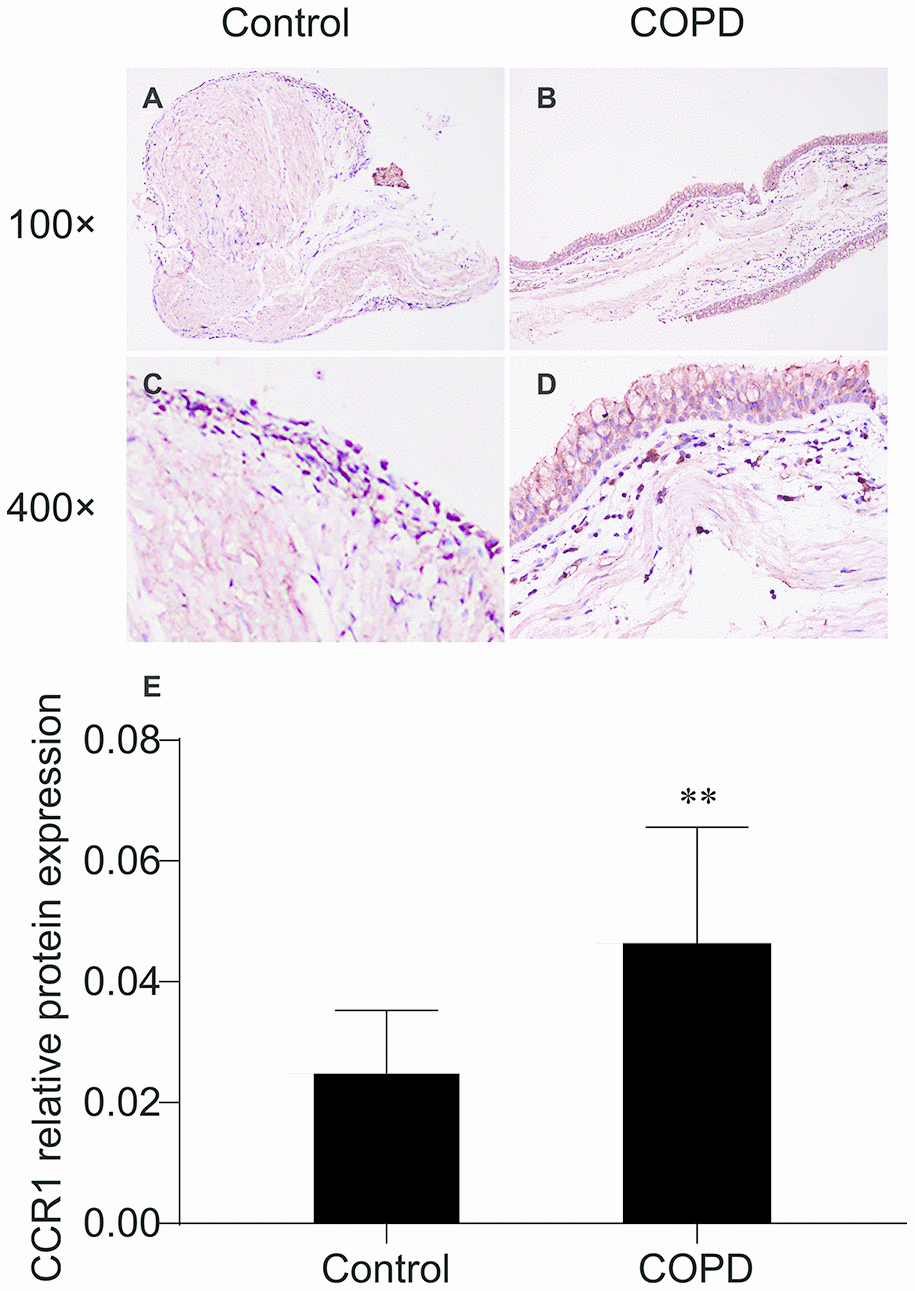 Cigarette smoke-induced lung inflammation in COPD mediated via CCR1/JAK ...