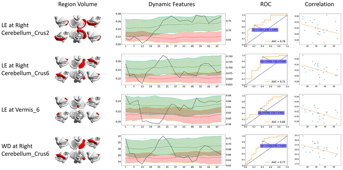 Abnormal Static And Dynamic Functional Connectivity Of Resting State