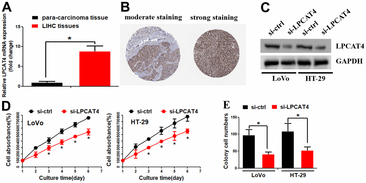 Pan-cancer analysis identifies LPCATs family as a prognostic biomarker and validation of LPCAT4 ...